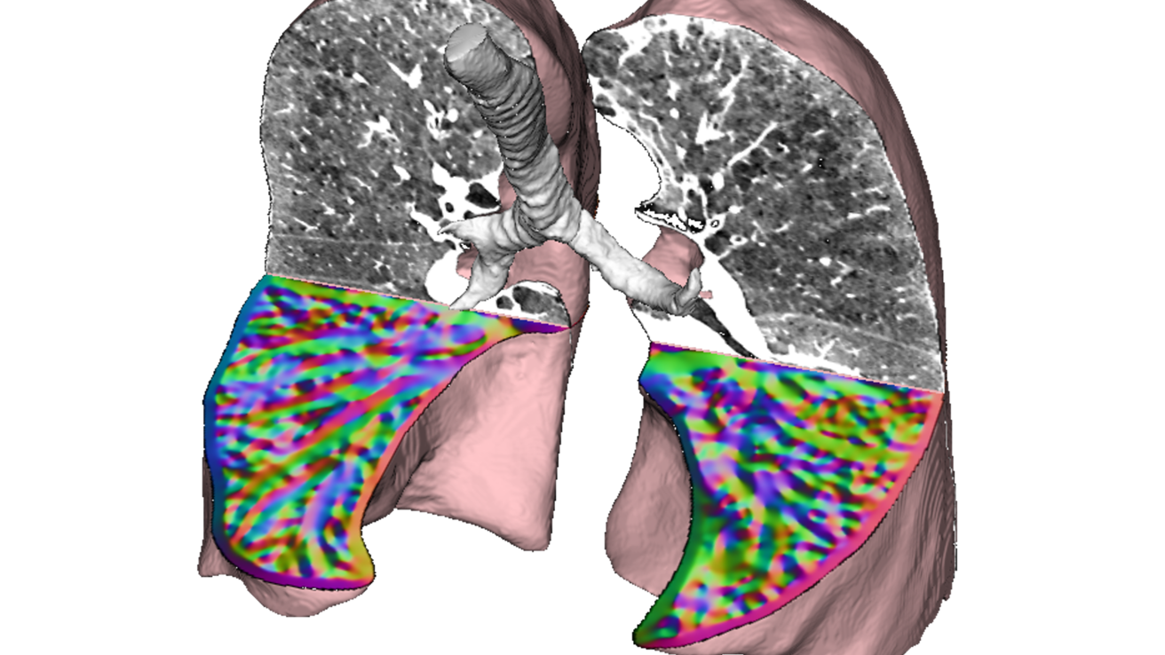 News | Pulmonary Imaging and Computer Vision Lab | The University of Iowa