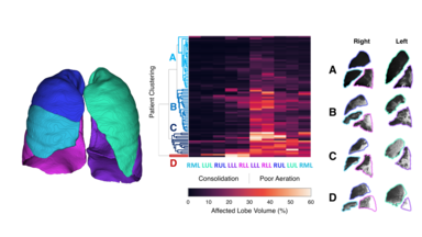 Pulmonary Structure | Pulmonary Imaging and Computer Vision Lab - The ...
